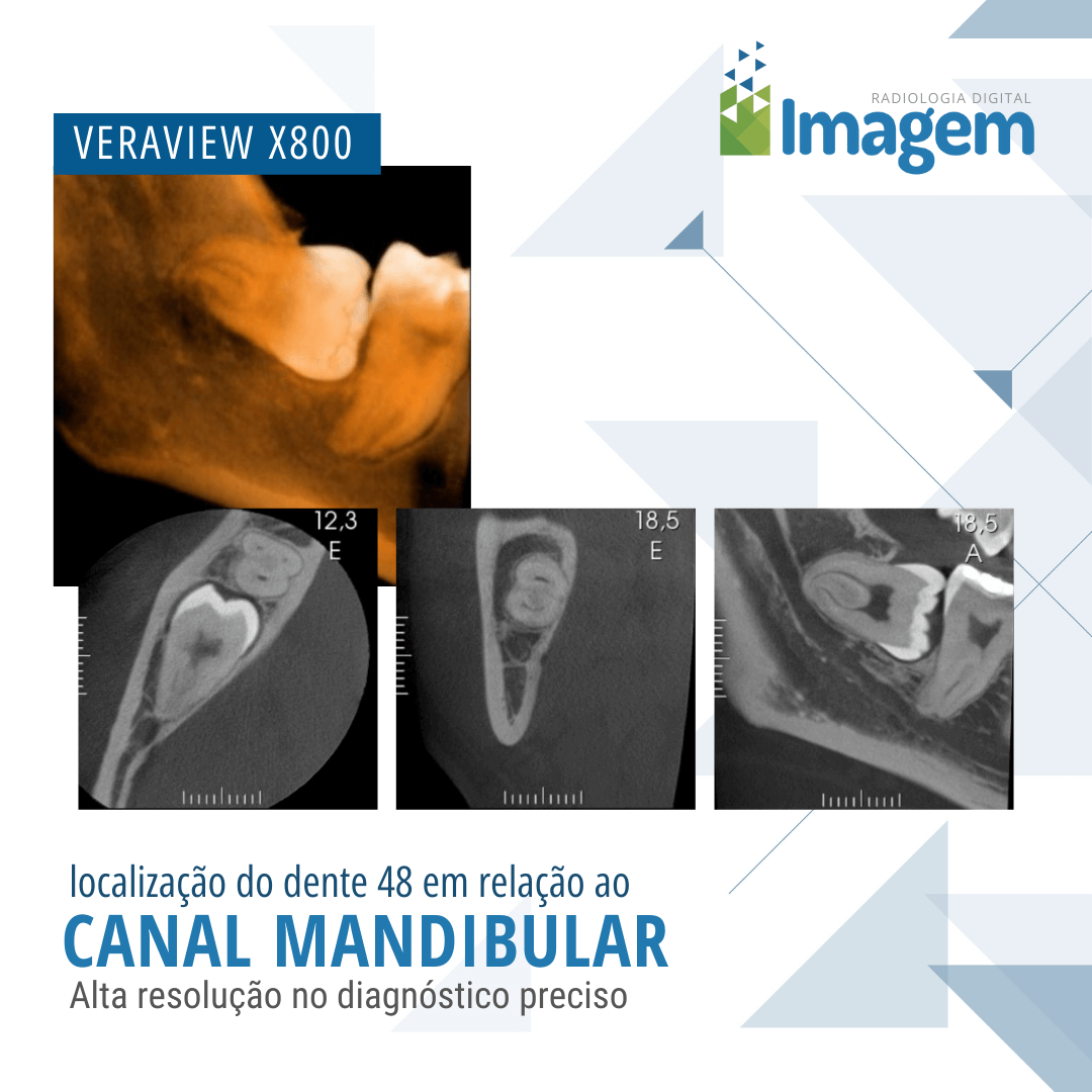 Localização do dente 48 em relação ao canal mandibular – Imagem Radiologia
