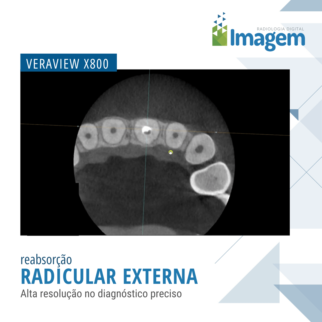 Reabsorção radicular externa – Imagem Radiologia