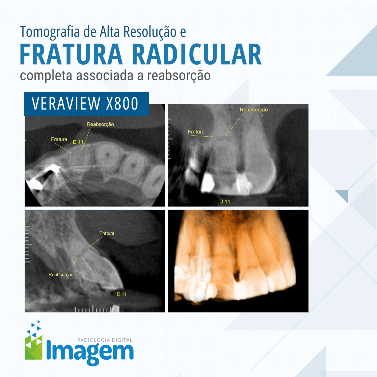 Tomografia de Alta Resolução e Fratura Radicular completa associada a ...